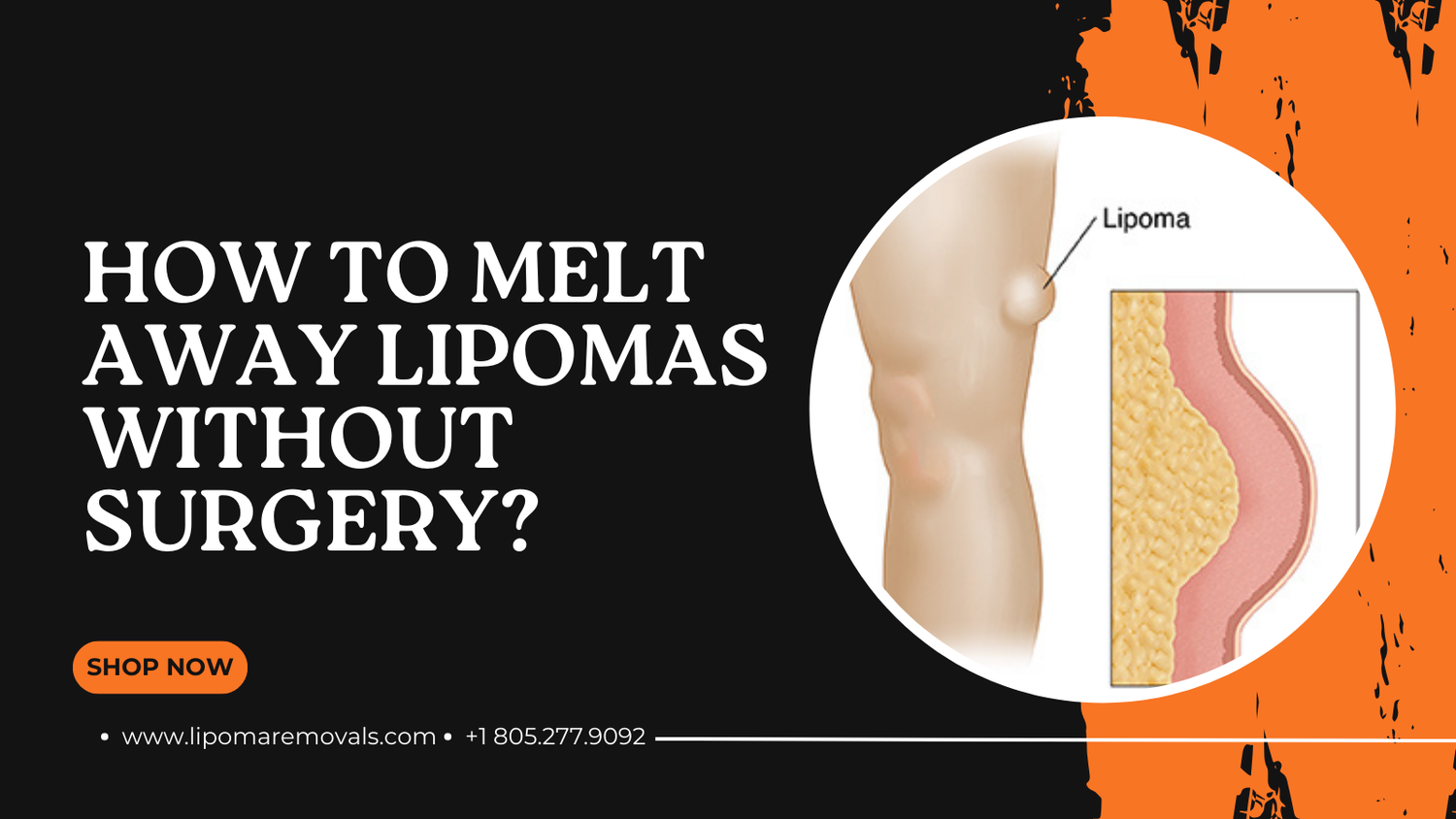 How To Melt Away Lipomas Without Surgery? – Lipoma Removals