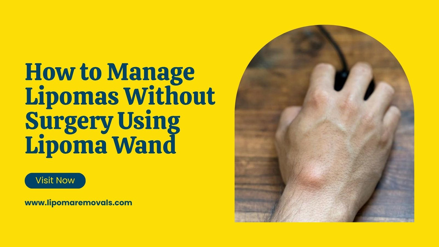 How to Manage Lipomas Without Surgery Using Lipoma Wand – Lipoma Removals