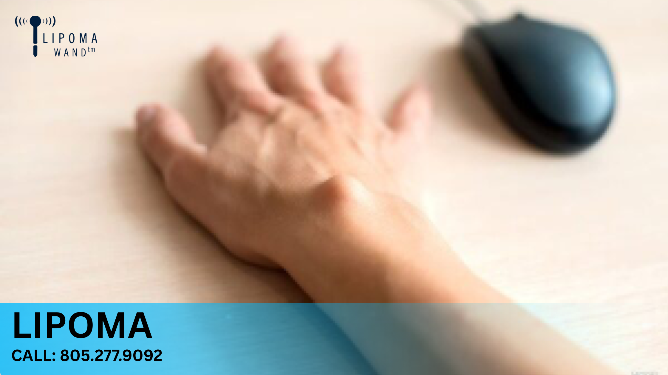 How to Remove Lipoma Yourself – Safe & Natural Alternatives for Lipoma ...