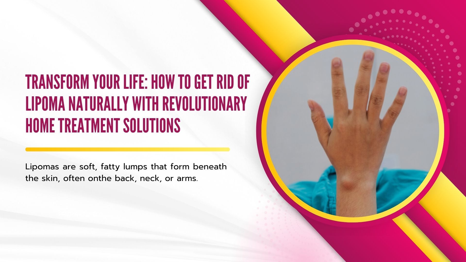 Transform Your Life: How to Get Rid of Lipoma Naturally with Revolutio ...